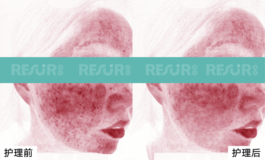 News - Understanding Acne Types and the Role of Skin Analysis Devices